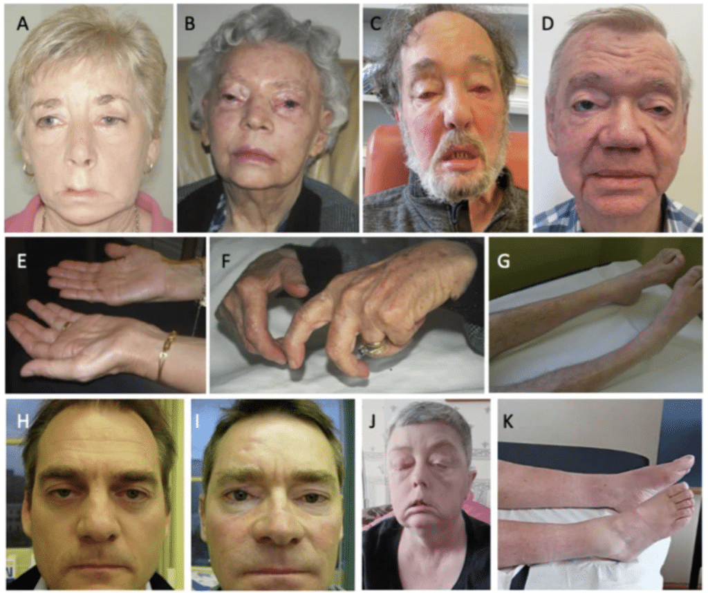 Perkins researchers discover muscle disease gene - Harry Perkins ...